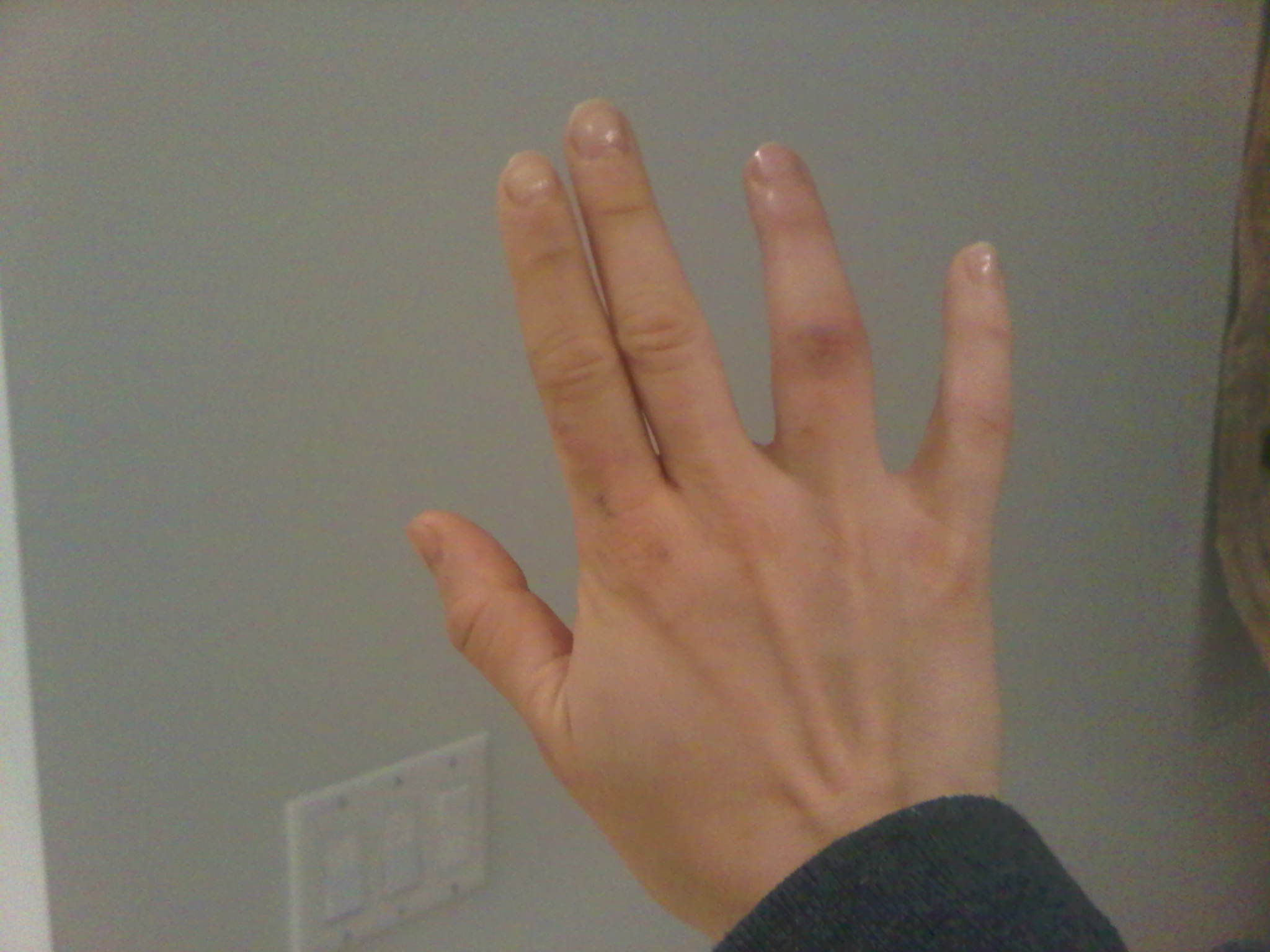 Arnica montana for dislocated fingers (with pictures) | Zettl Homeopathy